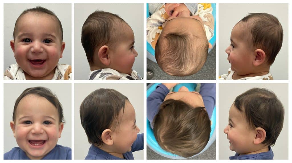 Plagiocephaly (treatment page) | London Orthotic Consultancy