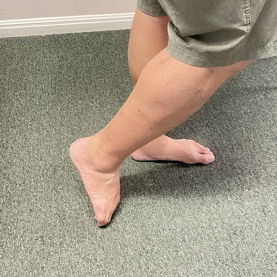 Drop foot (condition) | London Orthotic Consultancy