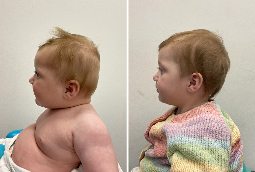 Bonnie's Plagiocephaly Treatment
