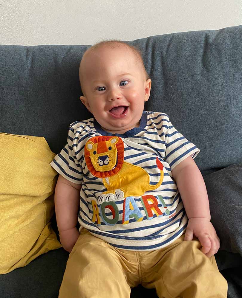 Jacob’s helmet therapy success after craniosynostosis surgery