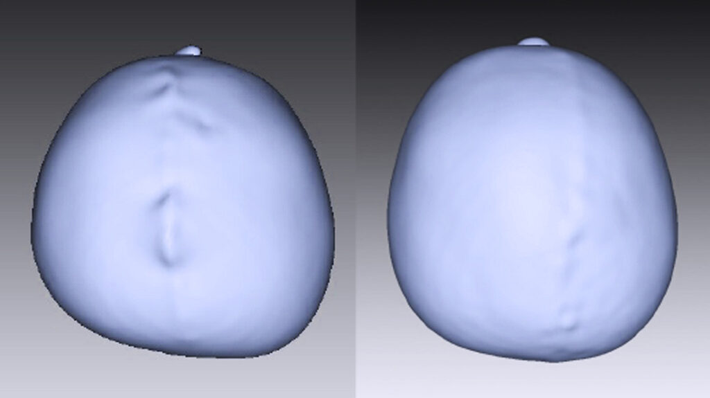 Ada’s severe brachycephaly improves with cranial remoulding therapy