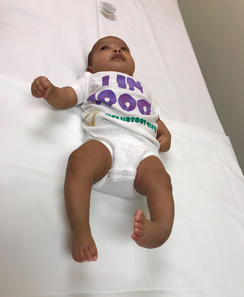 Cunningham Brace patients celebrate World Club Foot Day