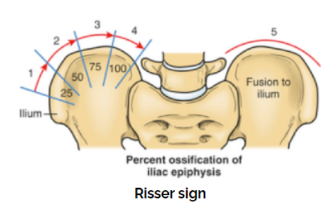 Understanding the Risser scale in scoliosis treatment - London Orthotic ...