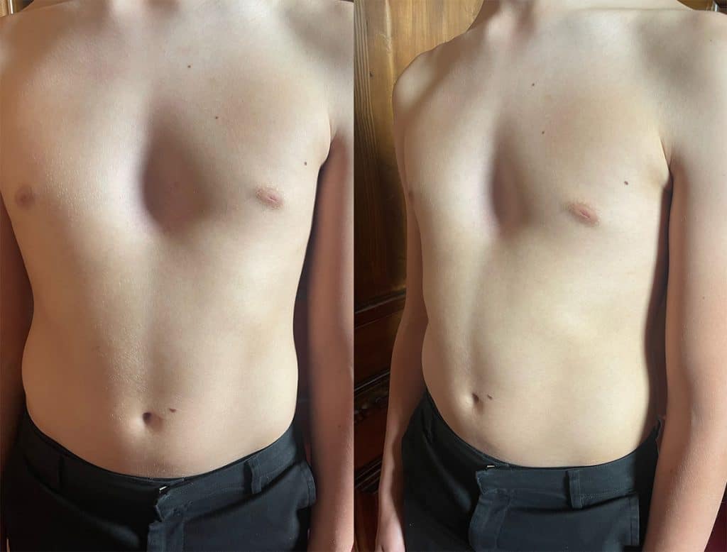 Alex achieved 100% correction of his chest shape thanks to vacuum bell ...