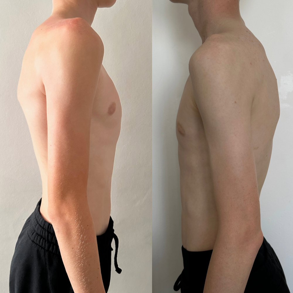 Pectus Excavatum vs Carinatum | Key Differences & Treatment Options